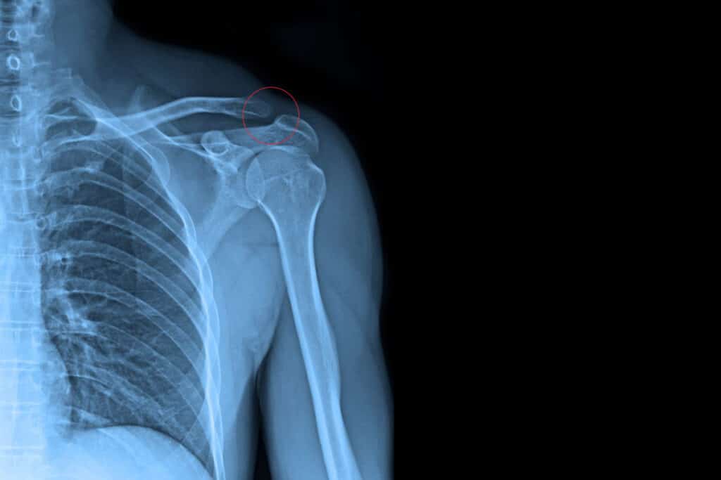 AC-Gelenksarthrose - wie kann Physiotherapie helfen? {2026}